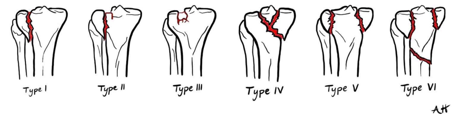 Tibial Plateau Fractures: the basics - BSM Foundation